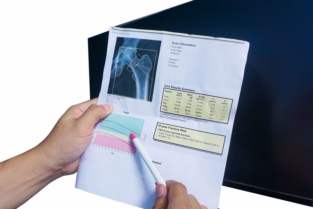 Understanding Your Bone Density - What are T-Scores and Z-Scores ...