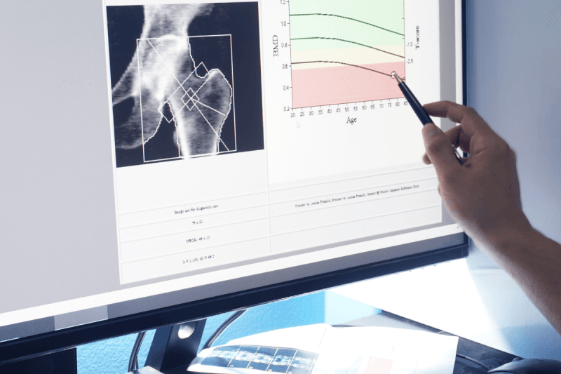 Understanding Bone Density: T-Scores and Z-Scores | Marodyne