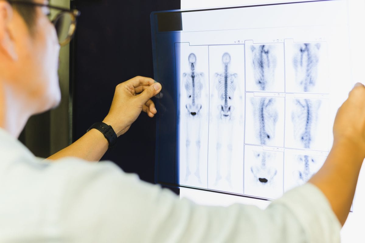 The CAROC Score for Assessing Fracture Risk | Marodyne