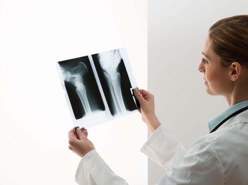 Osteopenia vs. Osteoporosis: Differences, Symptoms, Risks | Marodyne